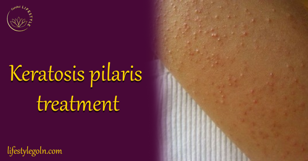 Understanding and Treating Keratosis Pilaris - Lifestyle Gurukul, GOLN